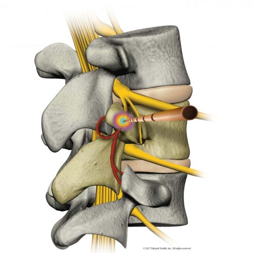 Lumbar Cooled Radiofrequency Pain Spa Lumbar Cooled Radiofrequency Pain Spa