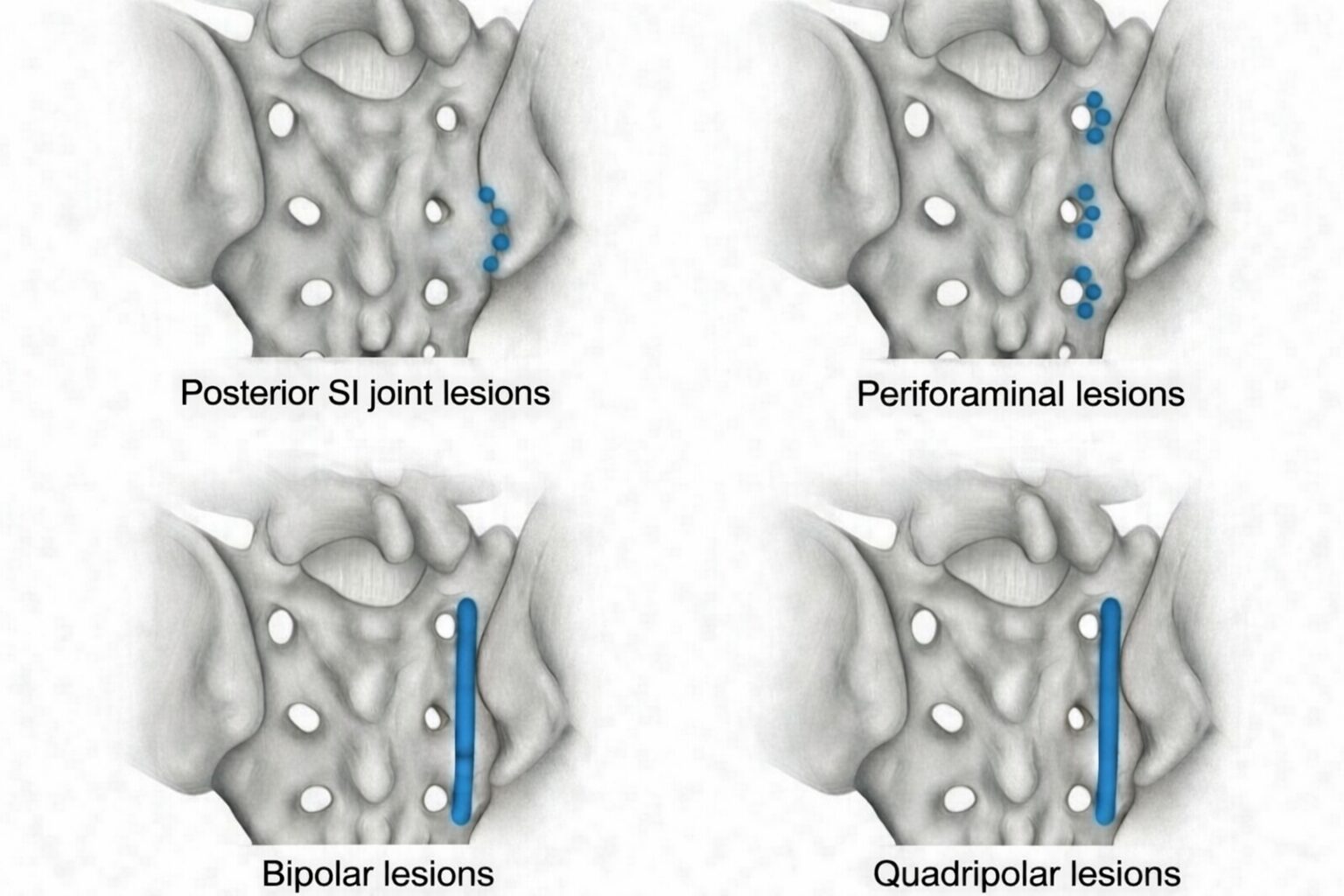 Sacroiliac Joint Pain: An Underdiagnosed Cause of Chronic Low Back and ...